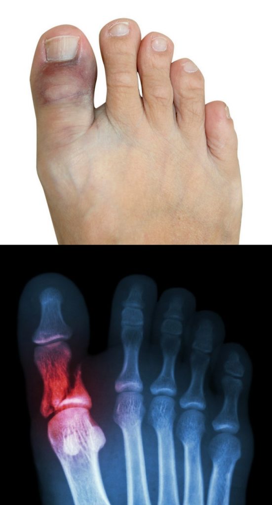Injured Big Toe Joint